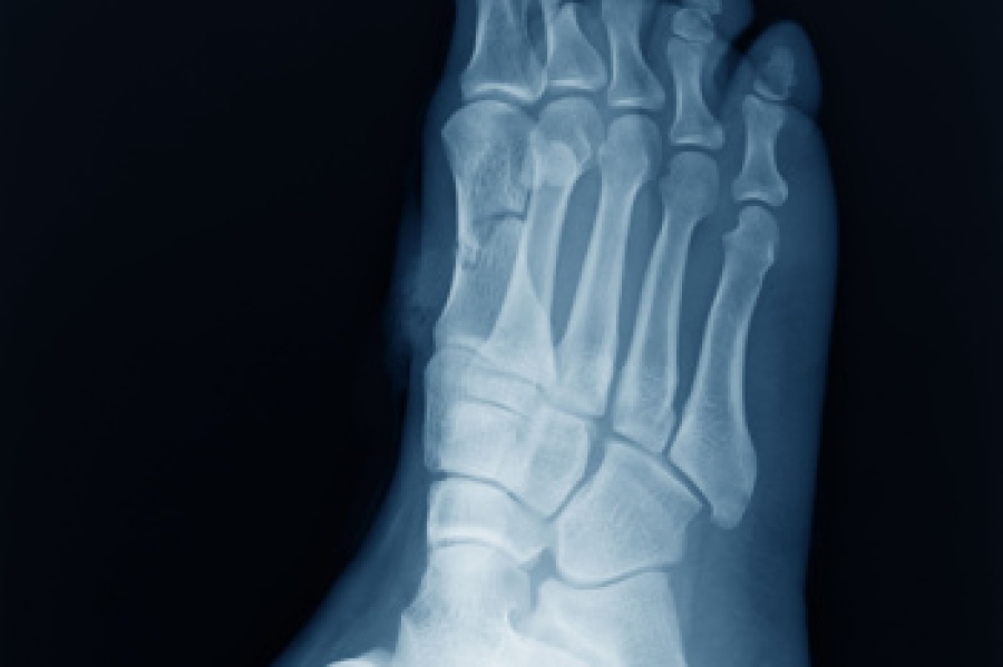 The Cuboid Bone Is Small but Essential for Foot Stability
